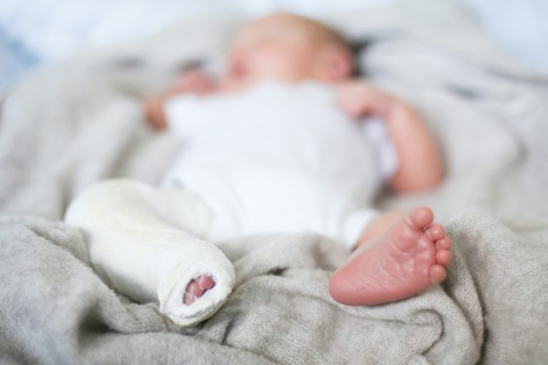 What is Clubfoot? - BabySparks